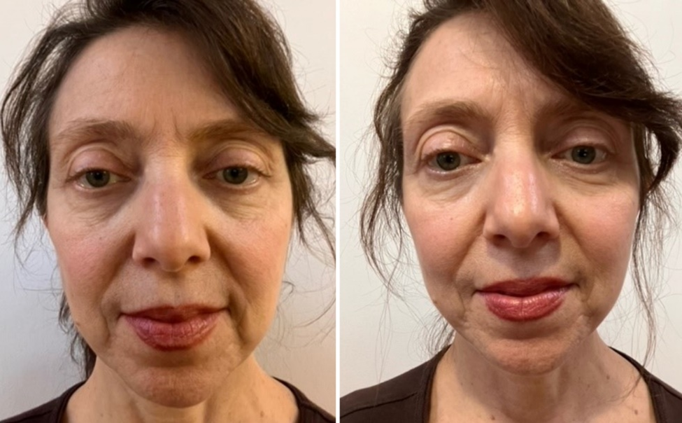 Elucent Anti-Ageing Range Before & After Photos